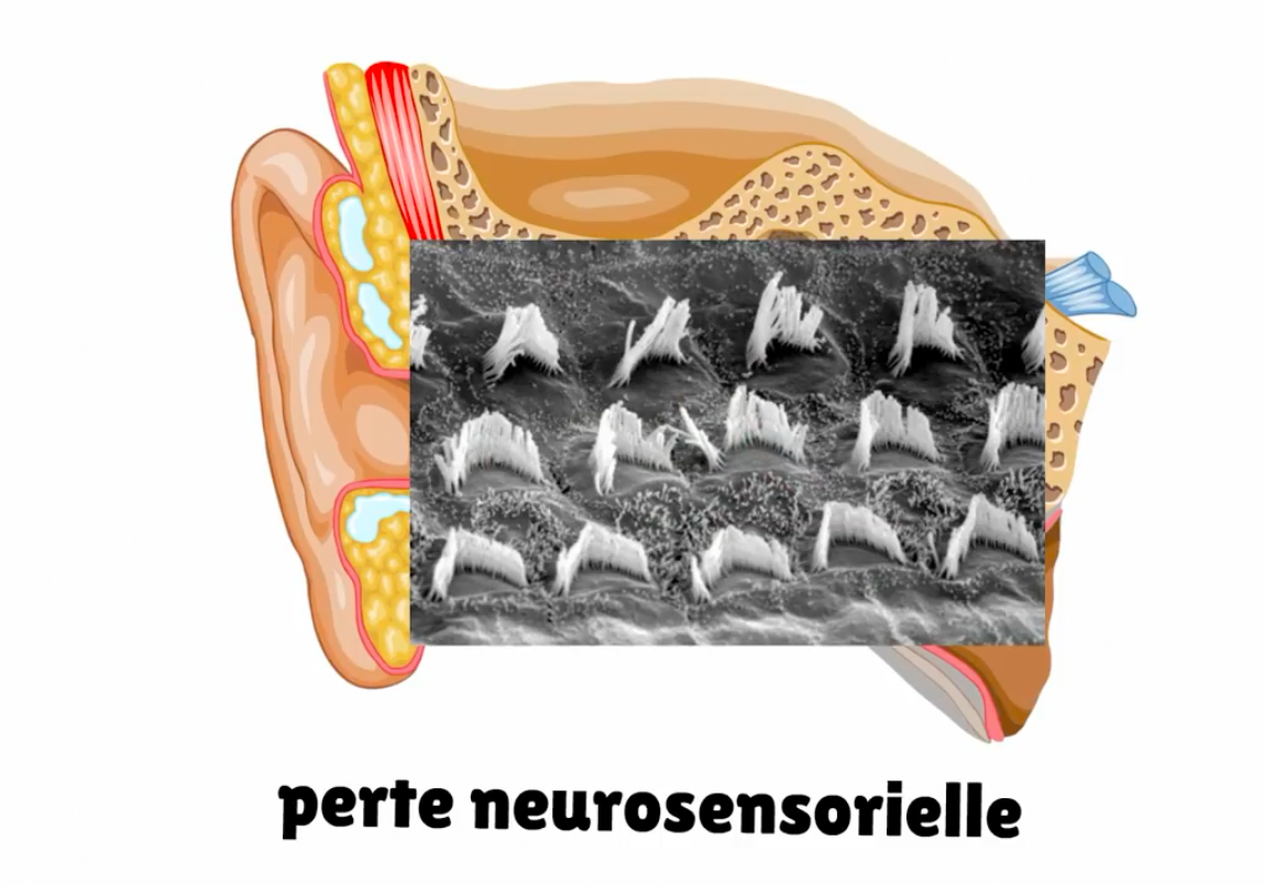 TROUBLE DE L'AUDITION / SURDITES - DISCRET'SON